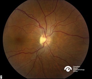 » Fuzzy vision and protein CCanadian Neuro-ophthalmology Group