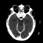 » Fuzzy vision and protein CCanadian Neuro-ophthalmology Group