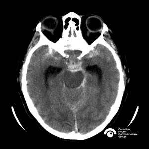 » Delayed double and droopCanadian Neuro-ophthalmology Group