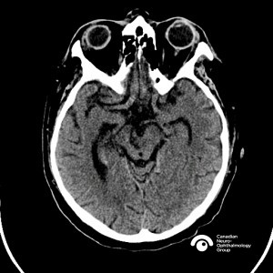 » Droop and double after a fallCanadian Neuro-ophthalmology Group