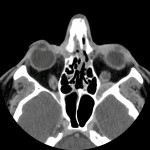 » Pain, double, droop and vision lossCanadian Neuro-ophthalmology Group