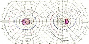 » A jiggling eye with a holeCanadian Neuro-ophthalmology Group