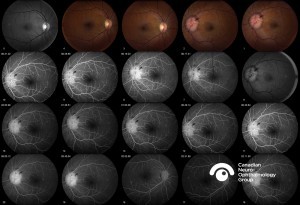 » Blinking vision in one eyeCanadian Neuro-ophthalmology Group