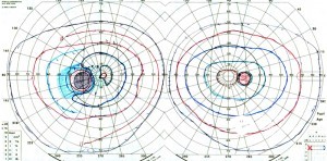 » Blinking vision in one eyeCanadian Neuro-ophthalmology Group