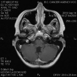 » Double comes, double goesCanadian Neuro-ophthalmology Group