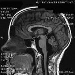 » Double comes, double goesCanadian Neuro-ophthalmology Group