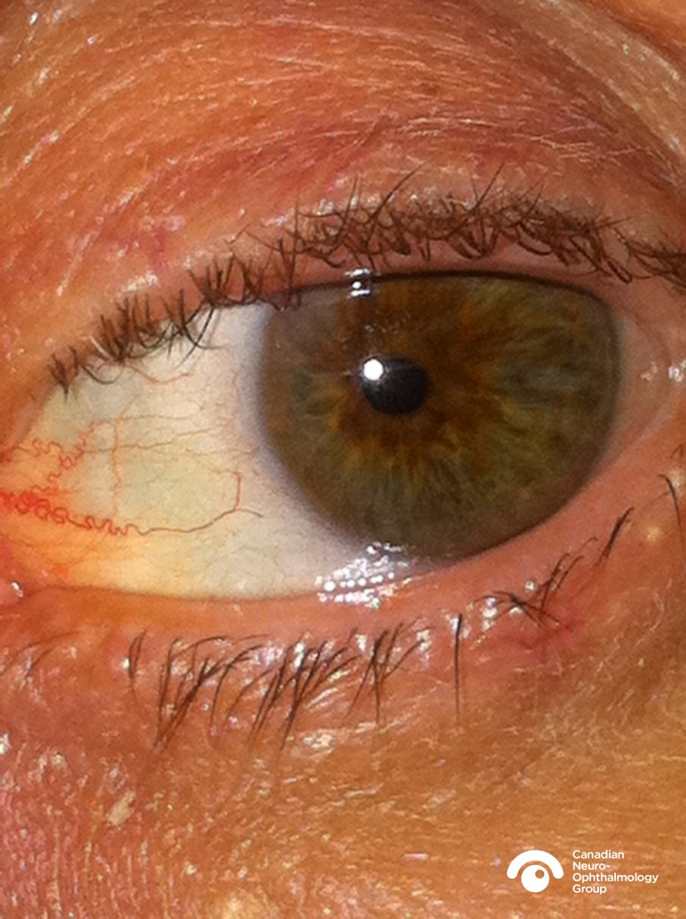 » The sideways pupilCanadian Neuro-ophthalmology Group