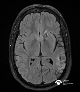 » A video, disc and MRI puzzleCanadian Neuro-ophthalmology Group