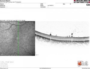 » Snow falling on retinaCanadian Neuro-ophthalmology Group