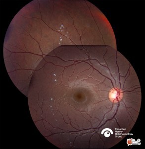 » Snow falling on retinaCanadian Neuro-ophthalmology Group