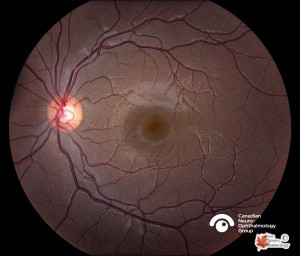 » Snow falling on retinaCanadian Neuro-ophthalmology Group
