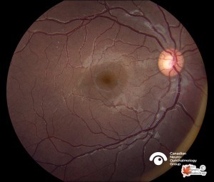 » Snow falling on retinaCanadian Neuro-ophthalmology Group