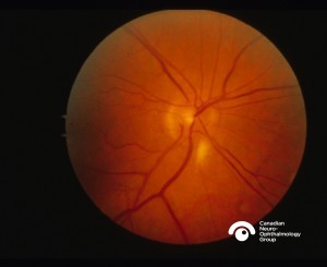 » 0028. Myelinated fibersCanadian Neuro-ophthalmology Group