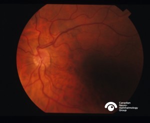 » 0082. Tilted disc/nasal fundal ectasiaCanadian Neuro-ophthalmology Group