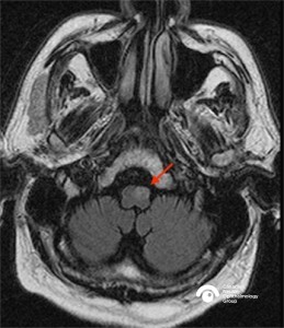 » Oculopalatal myoclonusCanadian Neuro-ophthalmology Group