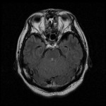 » ii. Internuclear ophthalmoplegia (INO)Canadian Neuro-ophthalmology Group