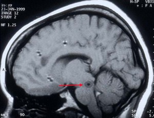 » ii. Internuclear ophthalmoplegia (INO)Canadian Neuro-ophthalmology Group
