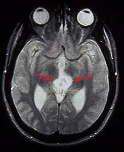 » iv. Prenuclear disorders of vertical gazeCanadian Neuro-ophthalmology ...