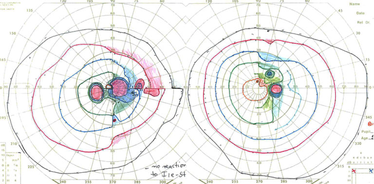 » Fielding a curve ballCanadian Neuro-ophthalmology Group