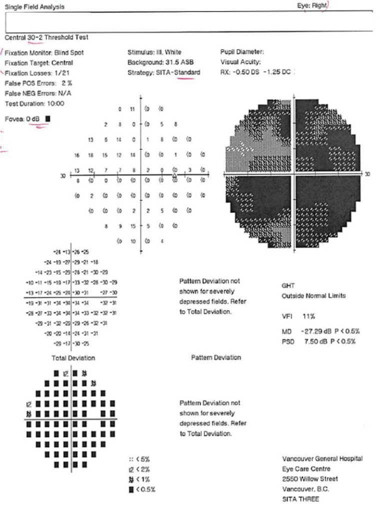 » A pressing matterCanadian Neuro-ophthalmology Group
