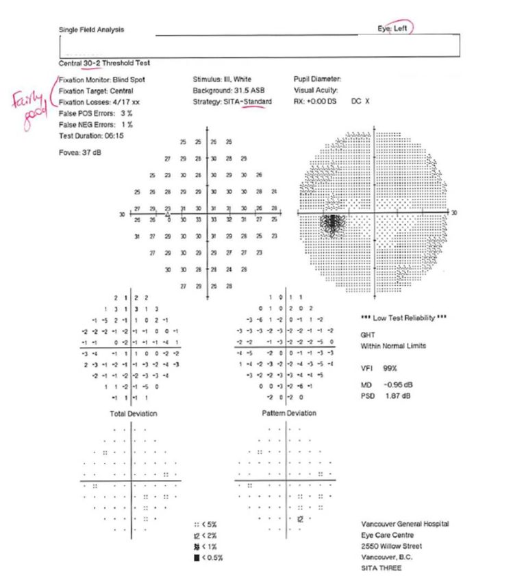 » A pressing matterCanadian Neuro-ophthalmology Group