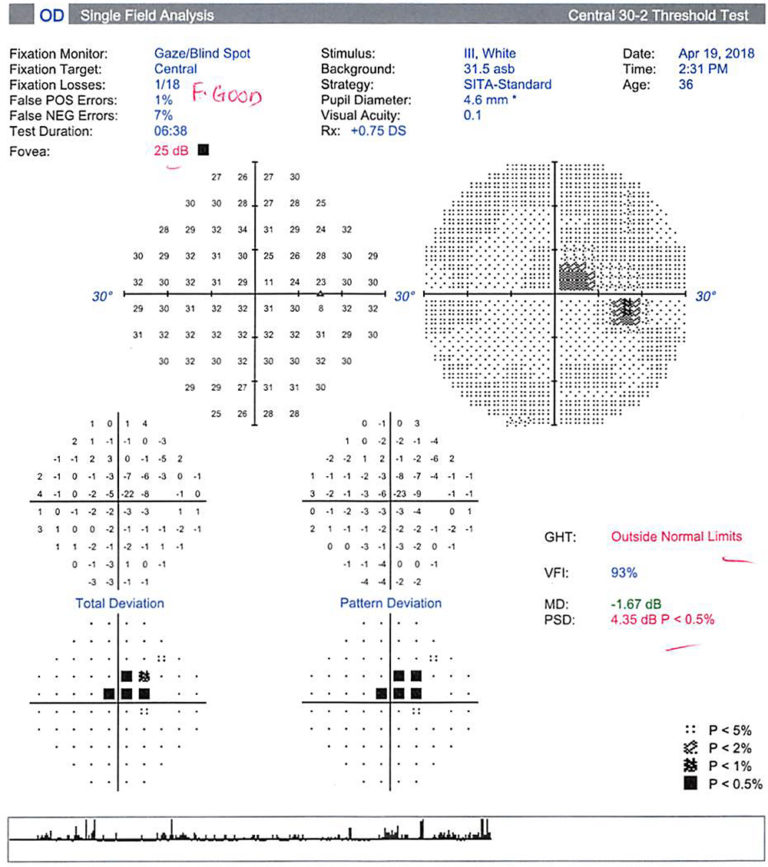 » The hole in the middleCanadian Neuro-ophthalmology Group