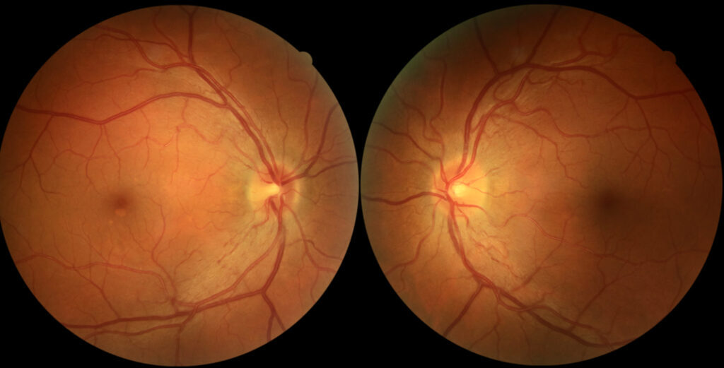 » One thing after another…Canadian Neuro-ophthalmology Group