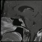 » The perils of falling downCanadian Neuro-ophthalmology Group