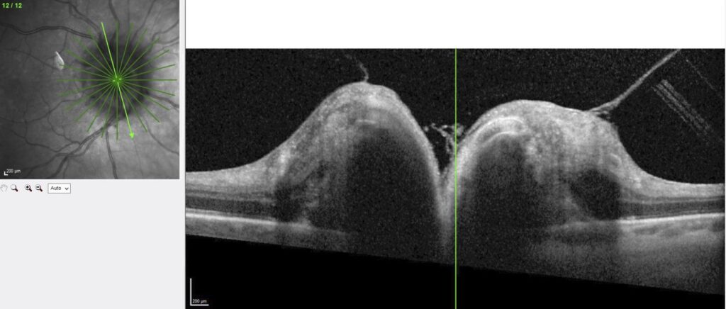 » A tense situationCanadian Neuro-ophthalmology Group