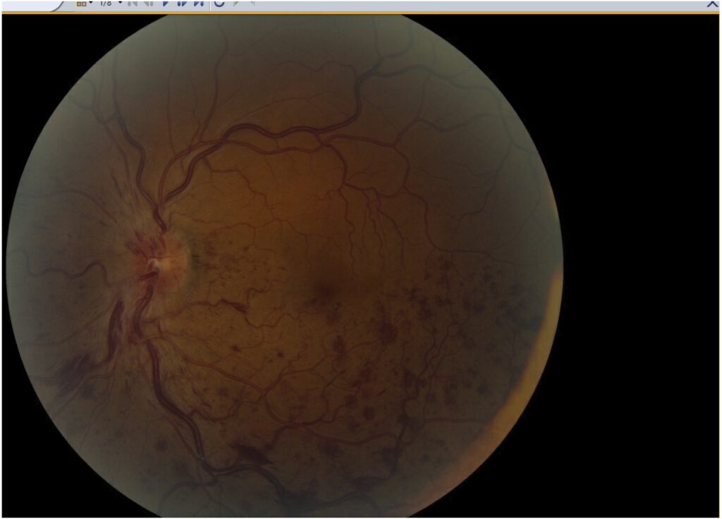 » Stand up and black out (one eye, anyway)Canadian Neuro-ophthalmology ...