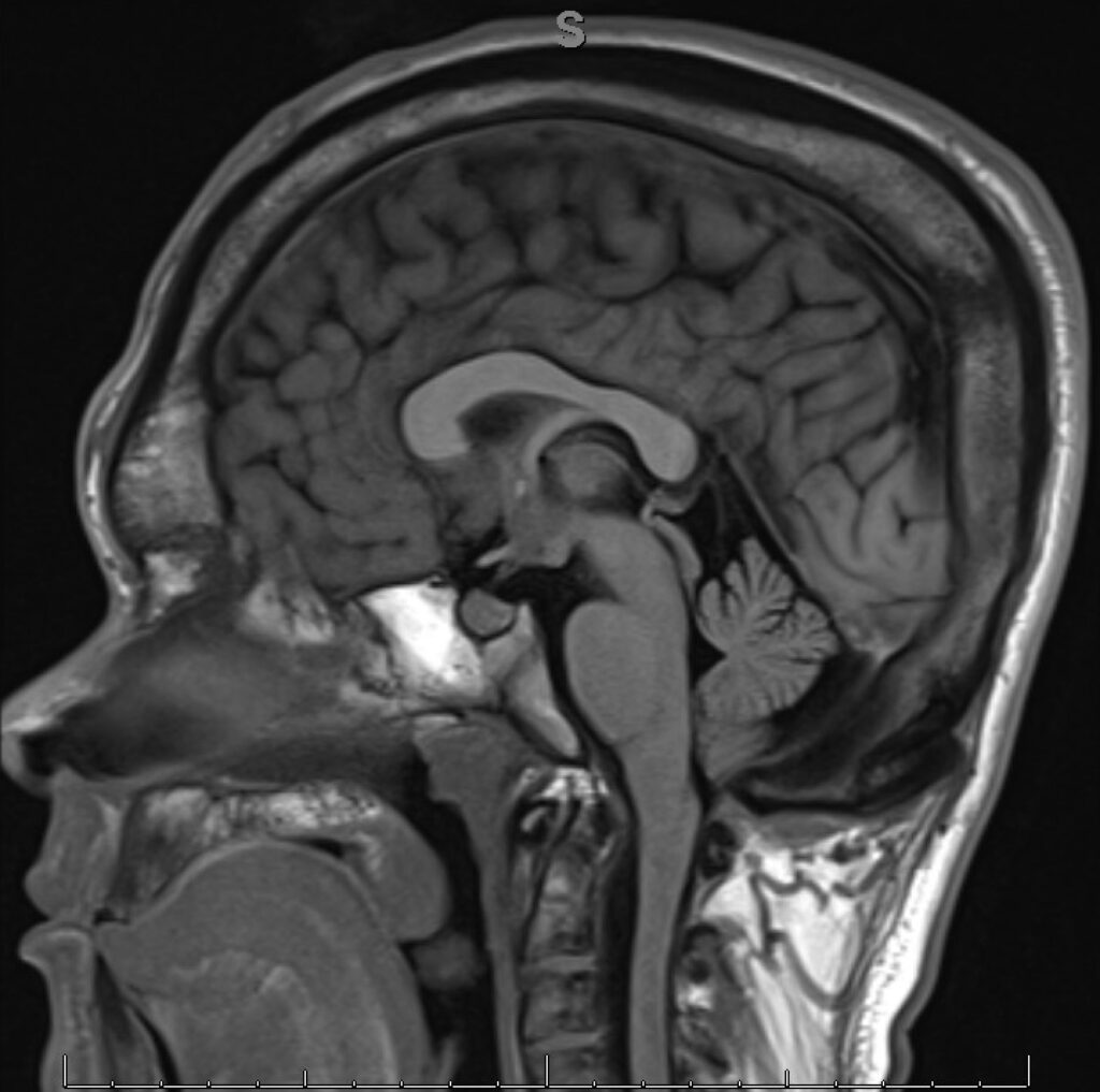 » The alpha maleCanadian Neuro-ophthalmology Group