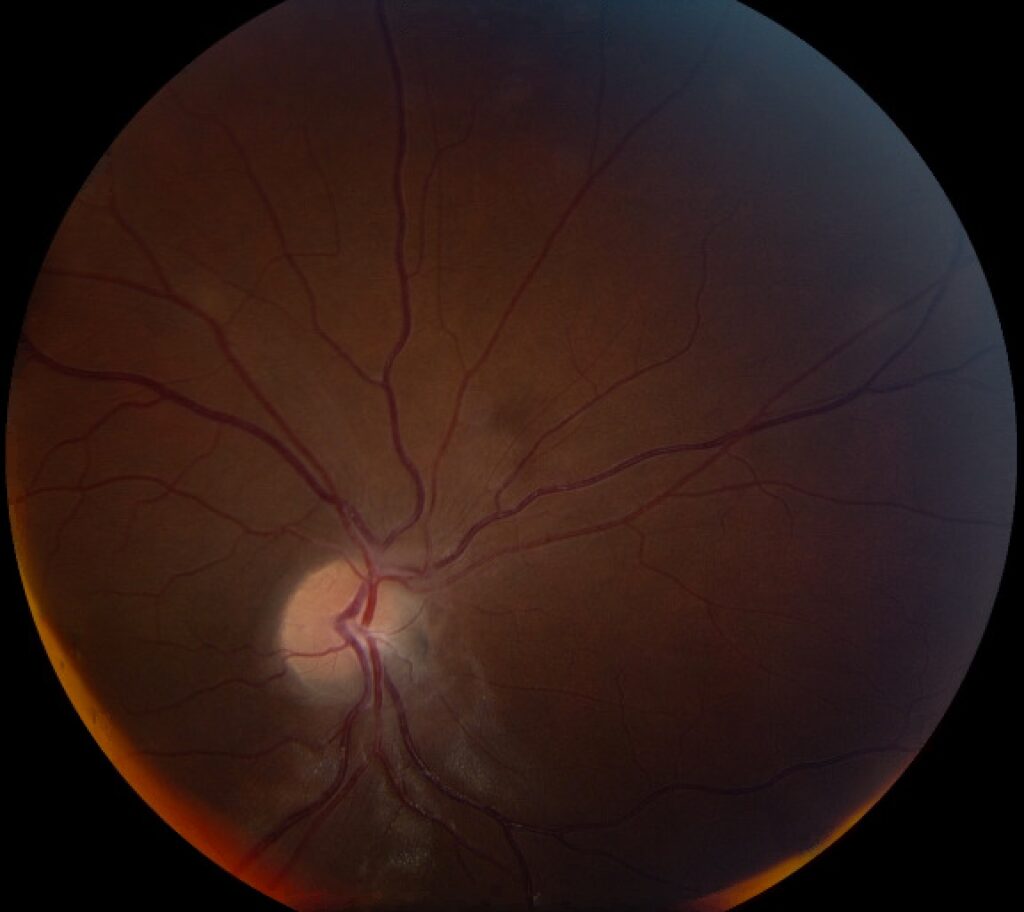 » The alpha maleCanadian Neuro-ophthalmology Group
