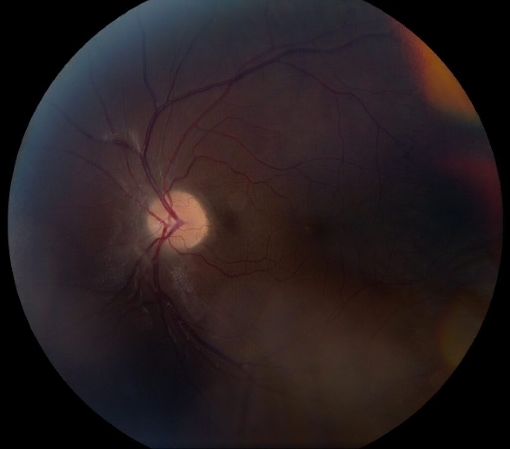 » The alpha maleCanadian Neuro-ophthalmology Group